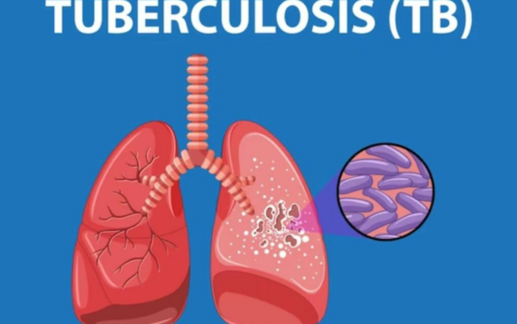 Guayas registra la mayor cantidad de casos de tuberculosis - Ecuador en ...
